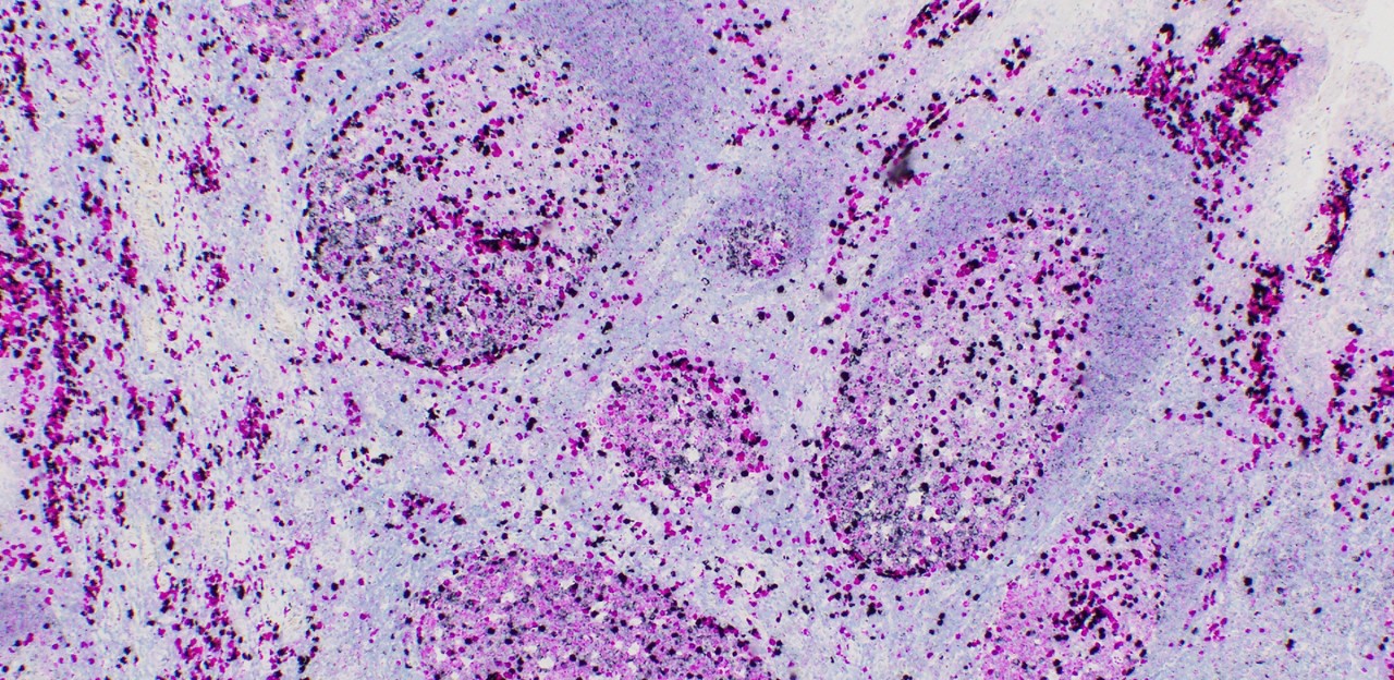2025: The future of cancer diagnostics in the pathology lab